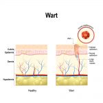Warts