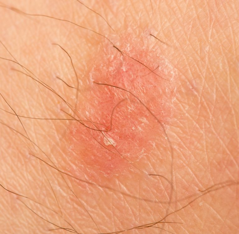 Fungal Infections fungal-infections