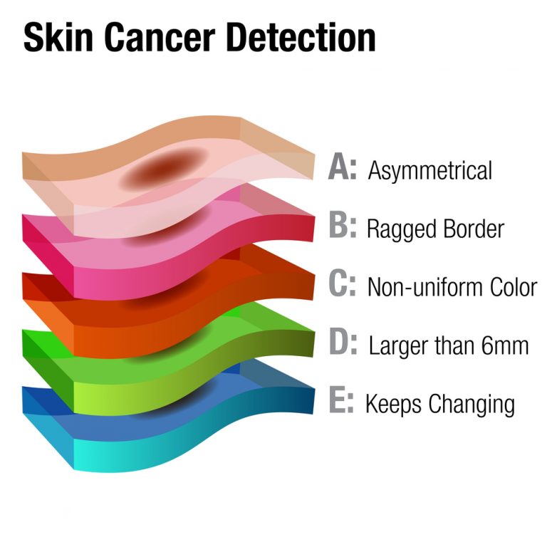 Skin Cancer Screening, Removal and Treatment